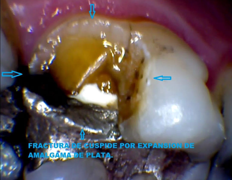 Galeria Fractura dental por expansión de amalgama de plata | Médicos de ...