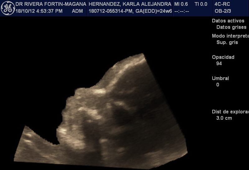 Imágenes de ultrasonografías en 3D, 2D y pruebas prenatales Galería en ...