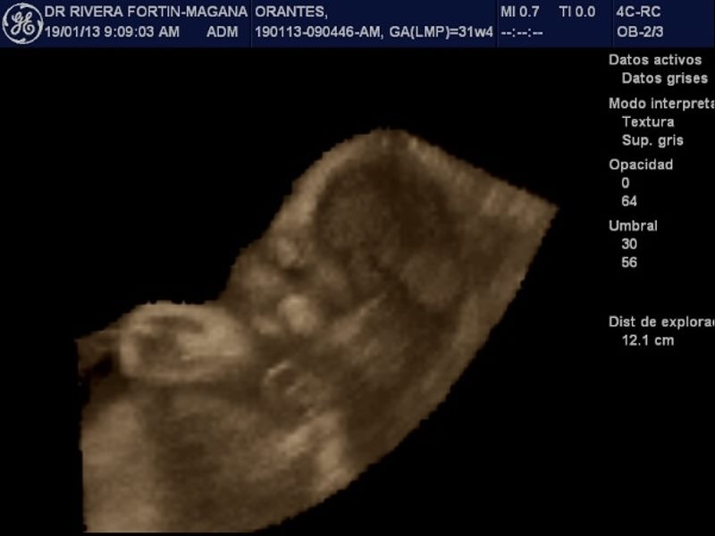 Galeria Imágenes de ultrasonografías en 3D, 2D y pruebas prenatales ...