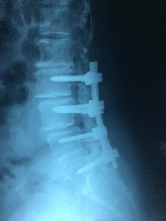 Artroplastía lumbar y prótesis de columna Galería en Médicos de El Salvador